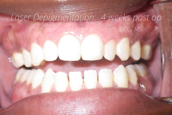 Esthetic Laser-Based Gum Treatments - Round Rock Periodontics - Ali ...