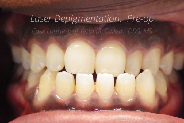 Esthetic Laser-Based Gum Treatments - Round Rock Periodontics - Ali ...