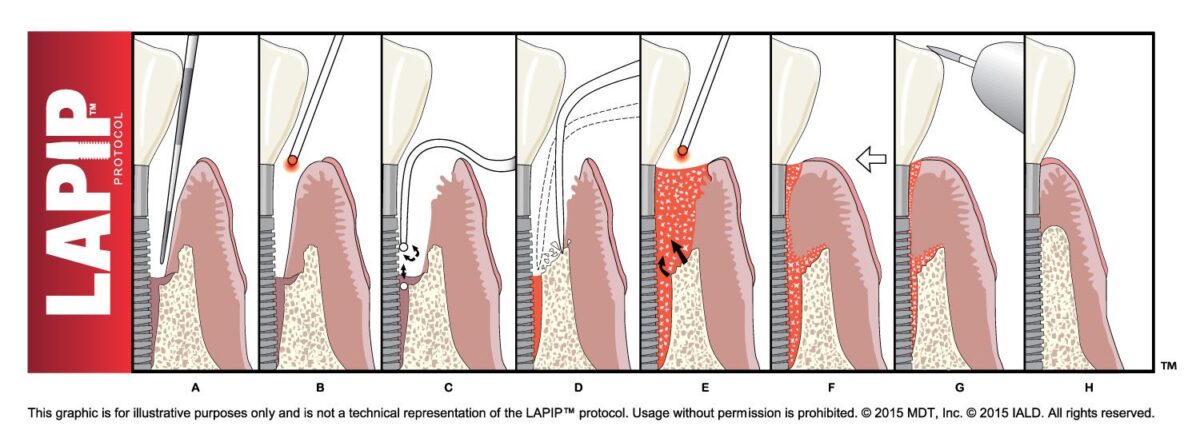 LAPIP® Protocol Dental Implant Gum Disease Treatment - Round Rock ...